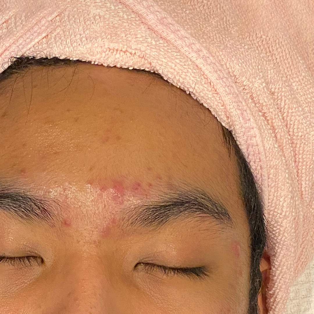 ACNE & OIL CONTROL FACIAL – Your Best You Medical Spa